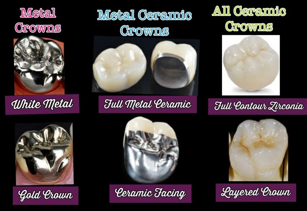 Cost Of Crown In Lucknow Zirconia Crown Cost In Lucknow Cost Of Crown In Lucknow Zirconia Crown Cost In Lucknow