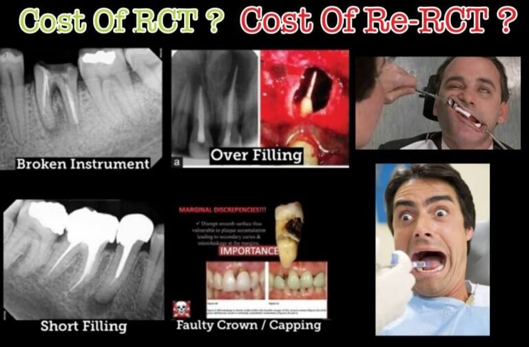 Cost of RCT/ReRCT - Cost of Root Canal Treatment